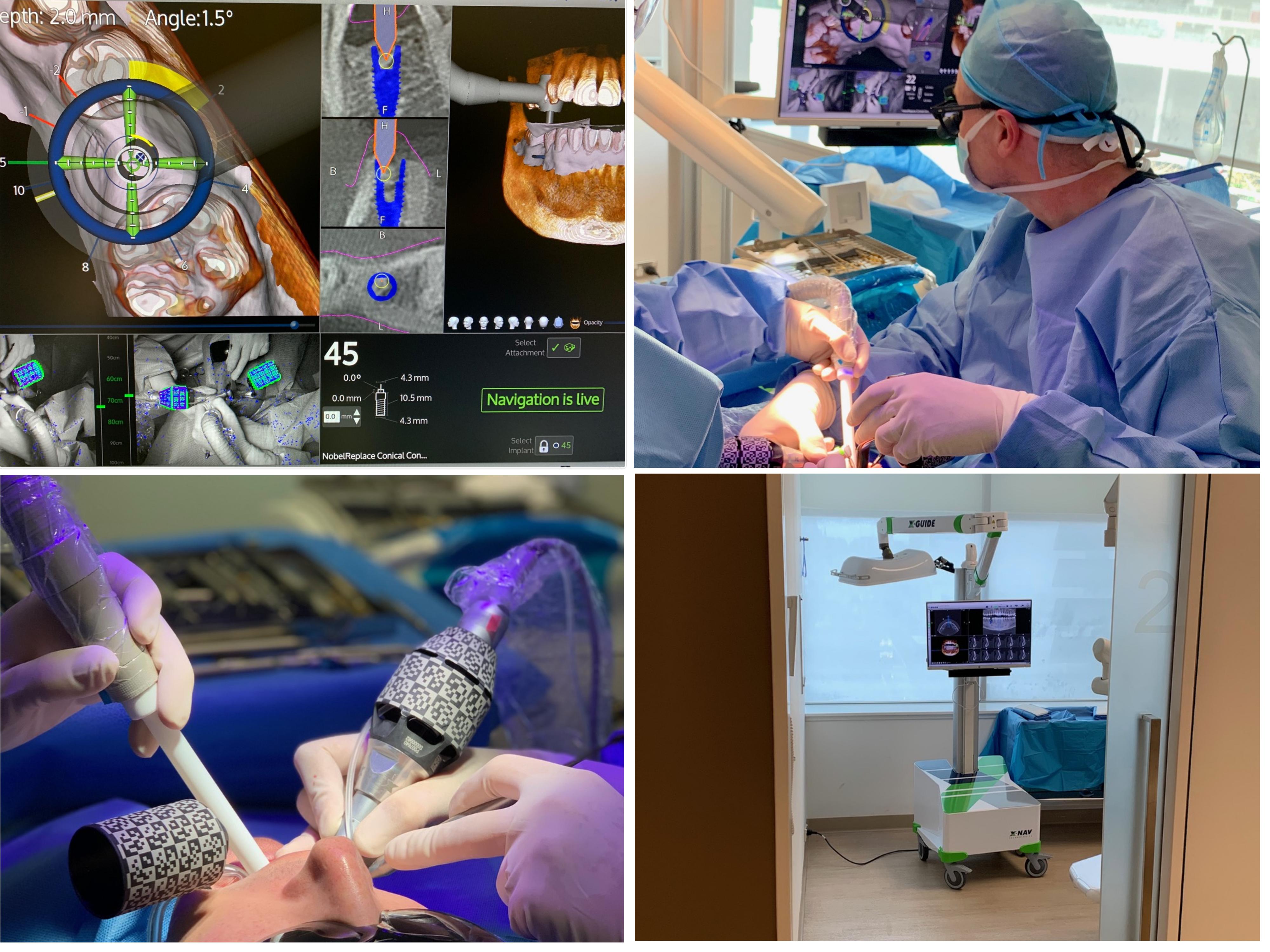 X-Guide Dynamic guided dental implant surgery | Institute of Dental ... X-Guide Dynamic guided dental implant surgery | Institute of Dental ...